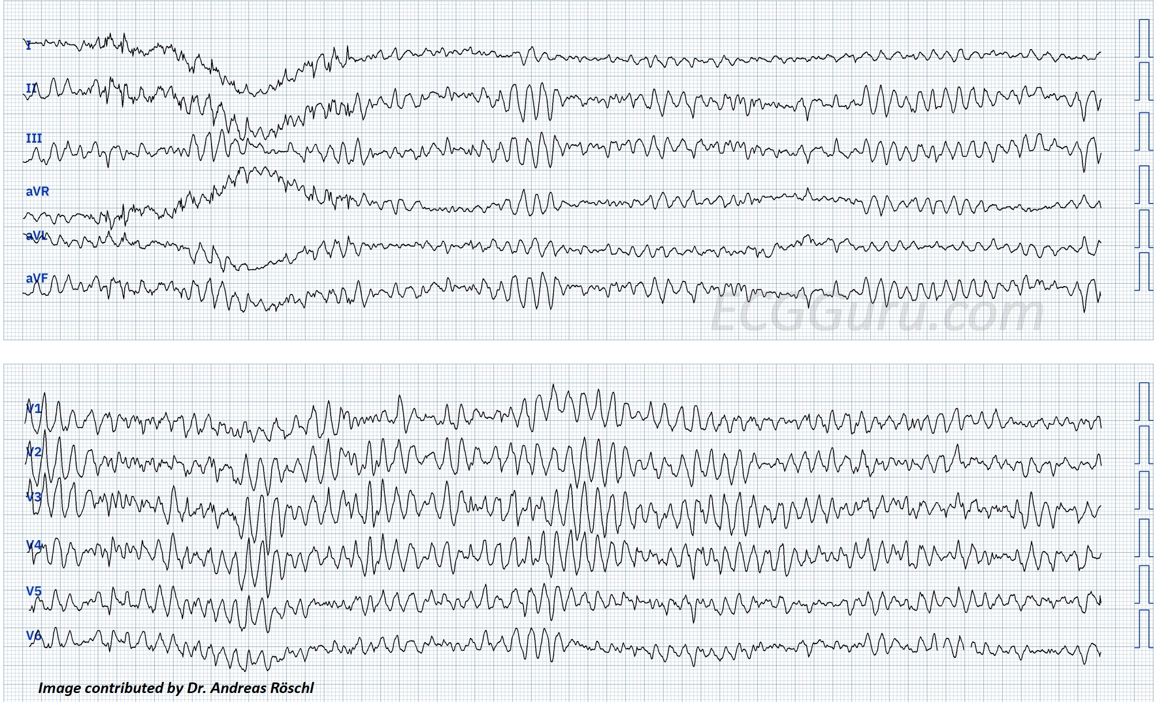 Vf Ecg Multiple The Ventricular Fibrillation (VF) ECG/EKG